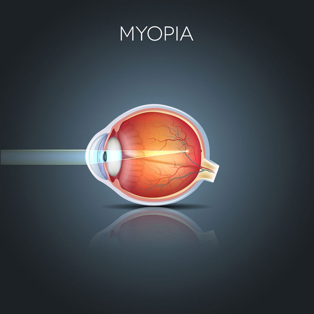 What is Myopia? (Nearsightedness) | Treatments | Mr Amit Patel